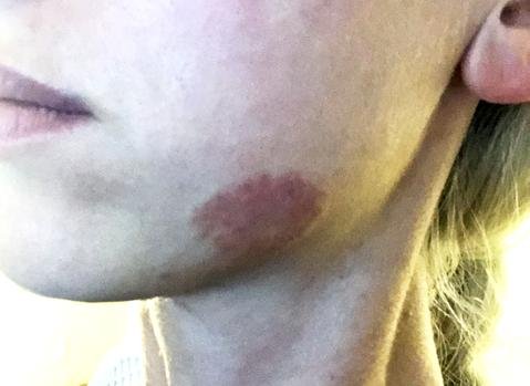 12 weeks ago I injured my face badly. Now the wound is completely gone ...