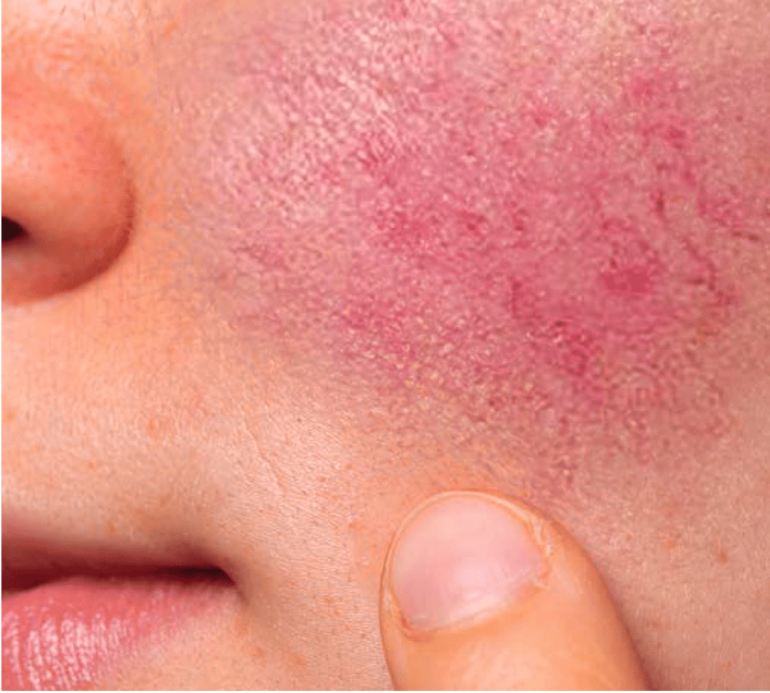6 Reasons why your skin is red and how to fix it – O U M E R E